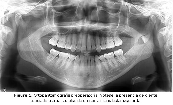 Supernumerario distomolar en rama mandibular asociado a quiste ...