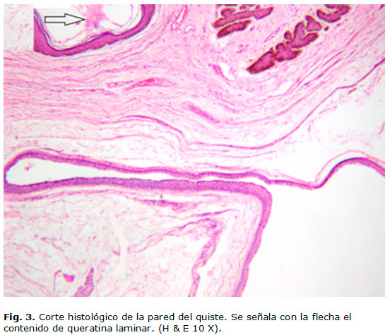 Quiste del rafe medio del pene. Presentación de un caso. | Rodriguez ...